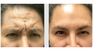 The Best BOTOX For Axillary Hyperhidrosis Bellevue & Kirkland