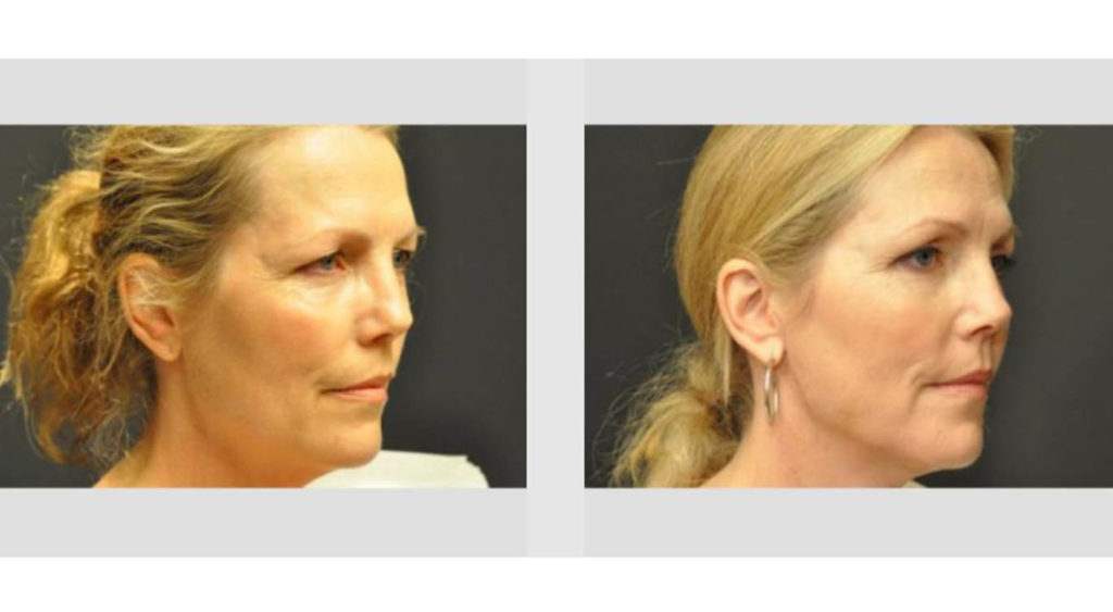 Deep Plane Facelift Bellevue & Kirkland | Gallery of Cosmetic Surgery