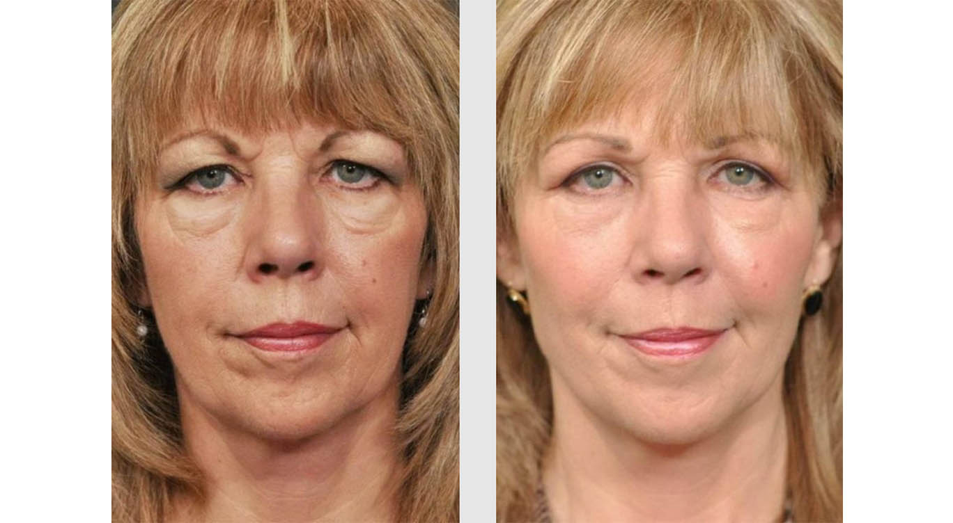 Cheek Filler Case 7 | Before & After Midface Injections