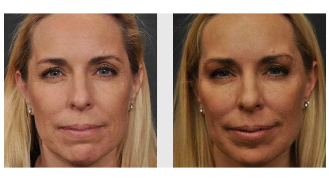 Patient Case #Injectable Fillers Case 23