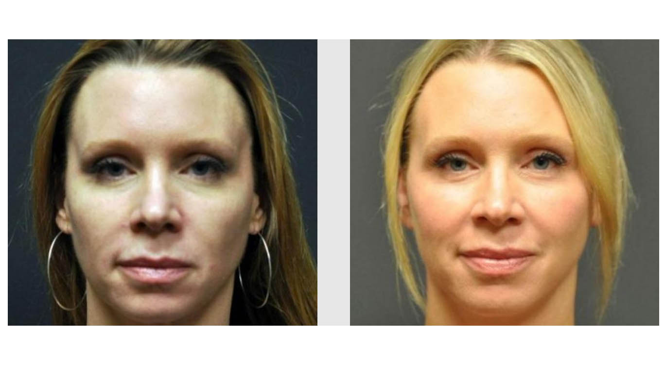 Patient Case #Injectable Fillers Case 22