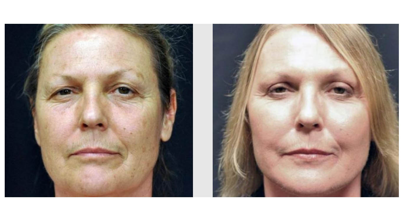 Patient Case #Injectable Fillers Case 16