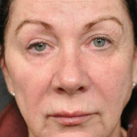 Fat Transfer Before and After Case 02 | Seattle Plastic Surgery