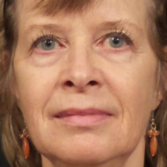 Fat Transfer Before and After Case 05 | Seattle Plastic Surgery