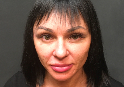Injectable Fillers Case 64 | The Gallery of Cosmetic Surgery