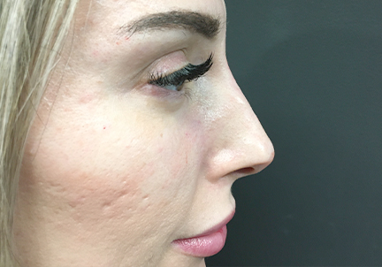 Non-Surgical Rhinoplasty Case 12 | Before & After Photos