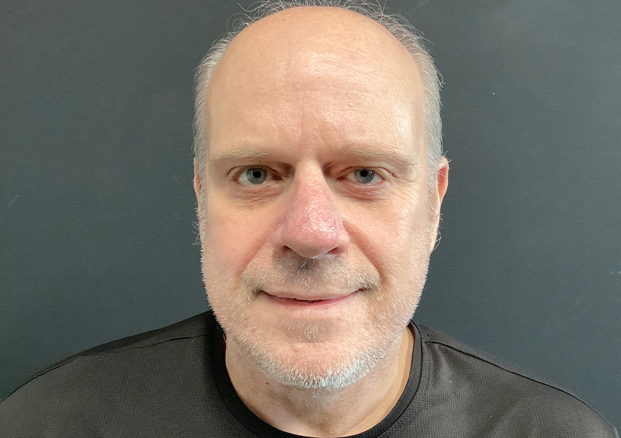 Patient Case Facelift Case 01